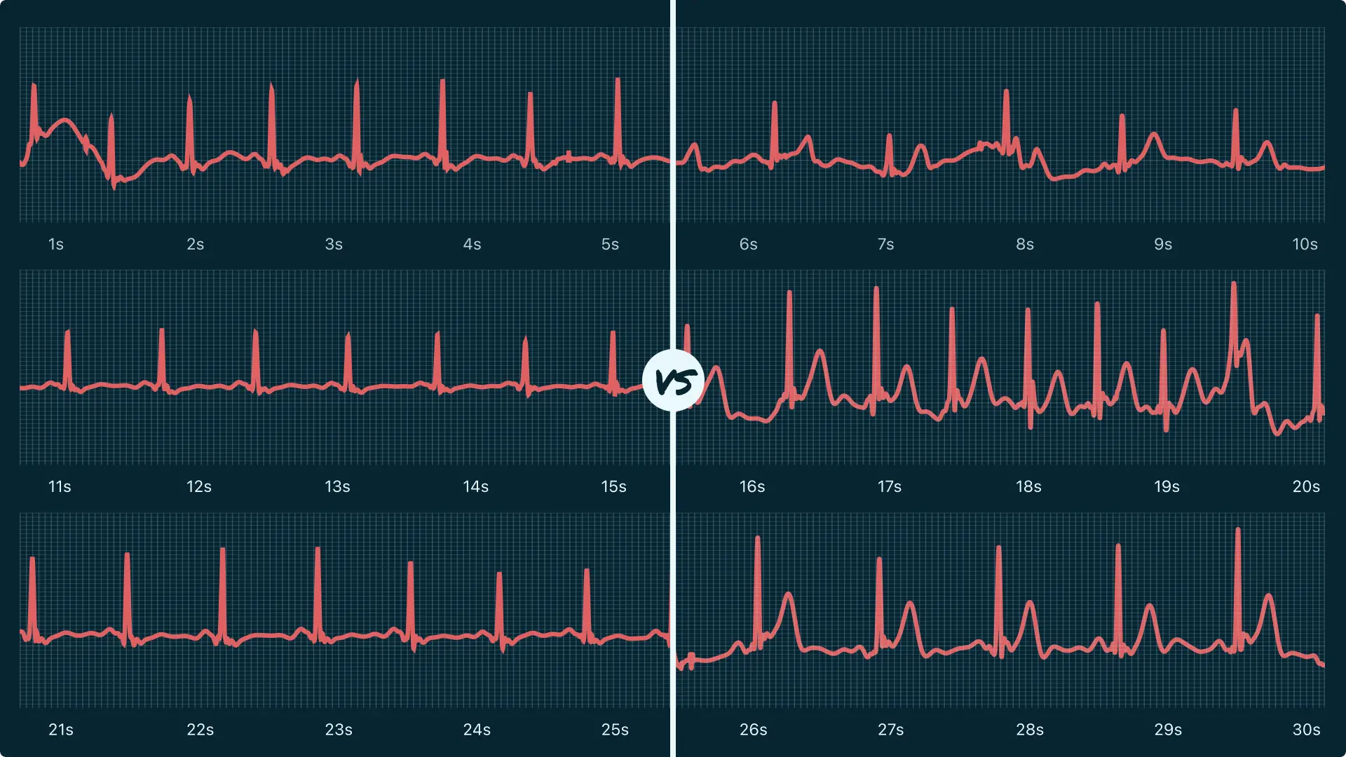 Sinus Arrhythmia Vs Atrial Fibrillation On Your Watch Ecg Qaly
